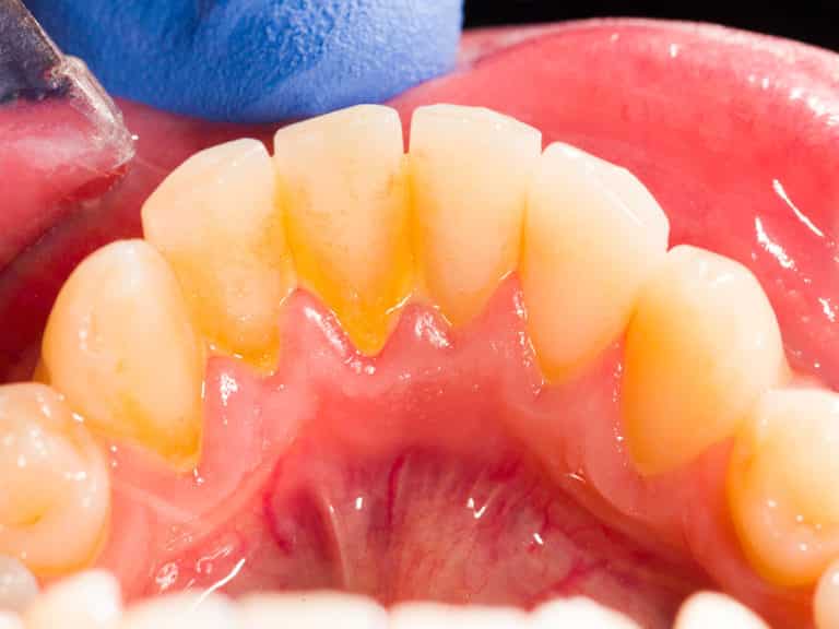 Successful Gum Disease Treatment In Buford